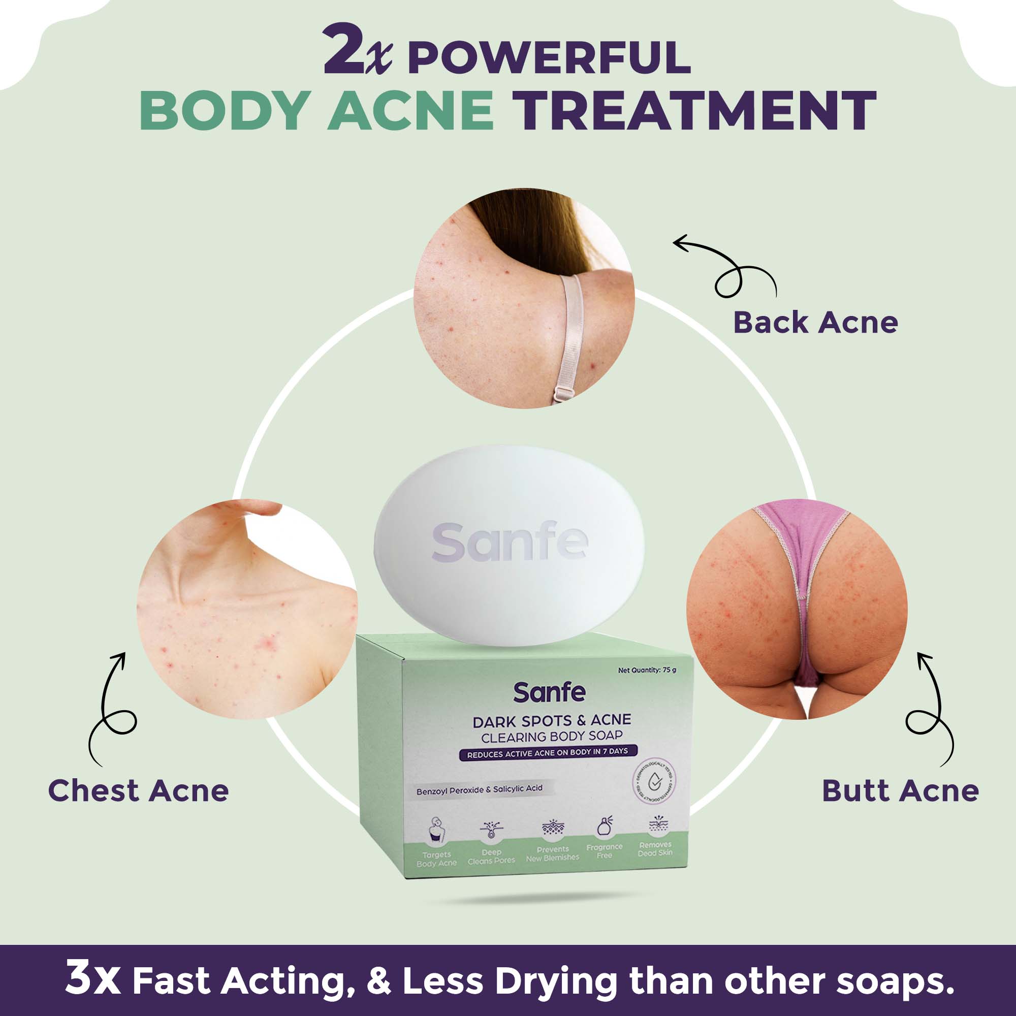 Dark Spots Acne Clearing Body Soap Pack of 3 Sanfe