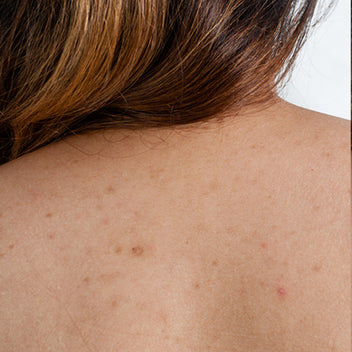 Dark Spots & Acne Clearing Body Wash – Sanfe